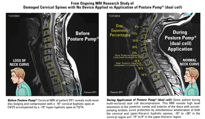 Wat is Expanding Ellipsoidal Decompression (EED®) en hoe werkt het ...